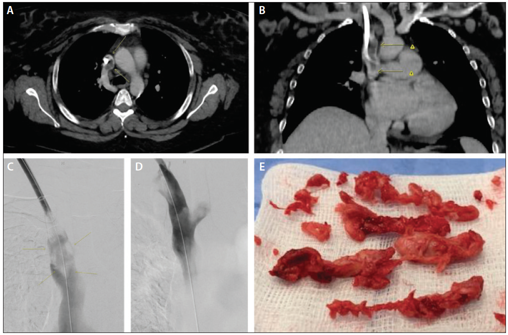 The VTE Paradigm Shift Continues: Nonthrombolytic Treatment of the ...