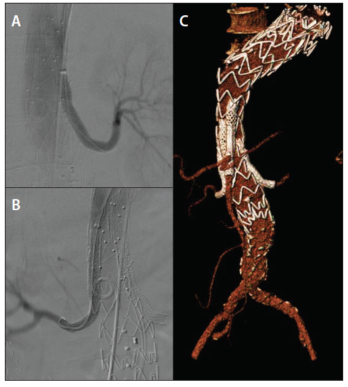 INNER-B Study: Evaluating the JOTEC E-nside TAAA Multibranch Stent ...