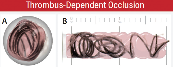 Ruby®, POD®, and Packing Coil: Immediate and Long-Term Mechanical ...
