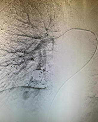 Ruby®, POD®, and Packing Coil: Immediate and Long-Term Mechanical ...