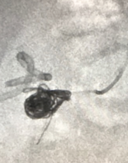 Ruby®, POD®, and Packing Coil: Immediate and Long-Term Mechanical ...