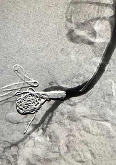 Ruby®, POD®, and Packing Coil: Immediate and Long-Term Mechanical ...