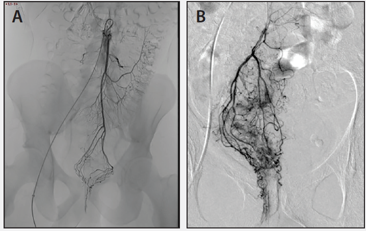 Ruby®, POD®, and Packing Coil: Immediate and Long-Term Mechanical ...