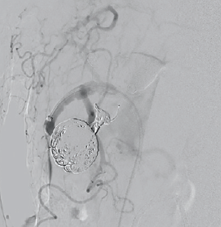 Ruby®, POD®, and Packing Coil: Immediate and Long-Term Mechanical ...