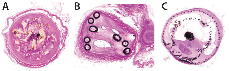 Shape Memory Polymer Technology - Endovascular Today