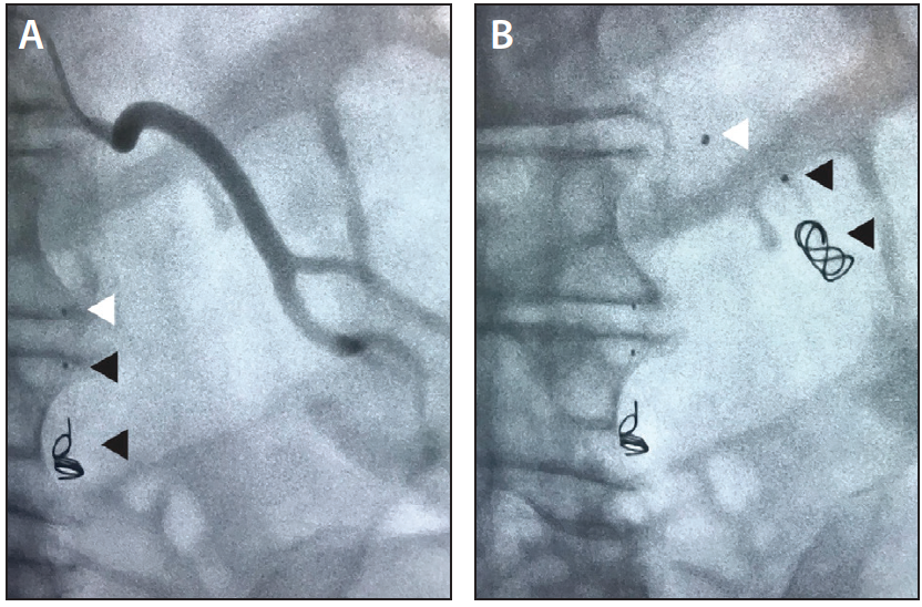 Shape Memory Polymer Technology - Endovascular Today