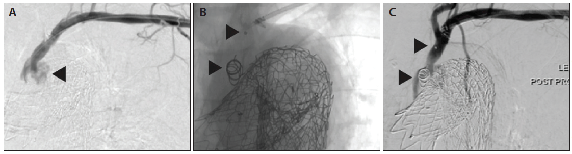 Shape Memory Polymer Technology - Endovascular Today