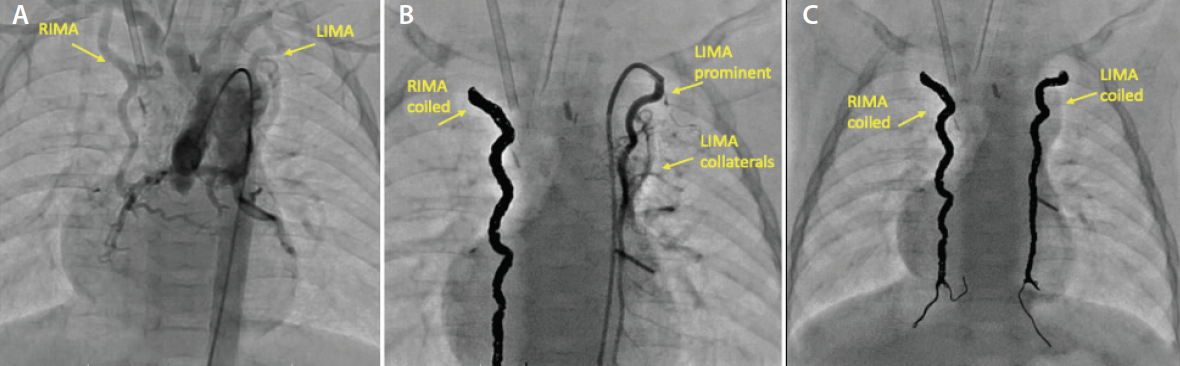 A Coil for Every Case: Achieving Volume and Softness With the Penumbra ...