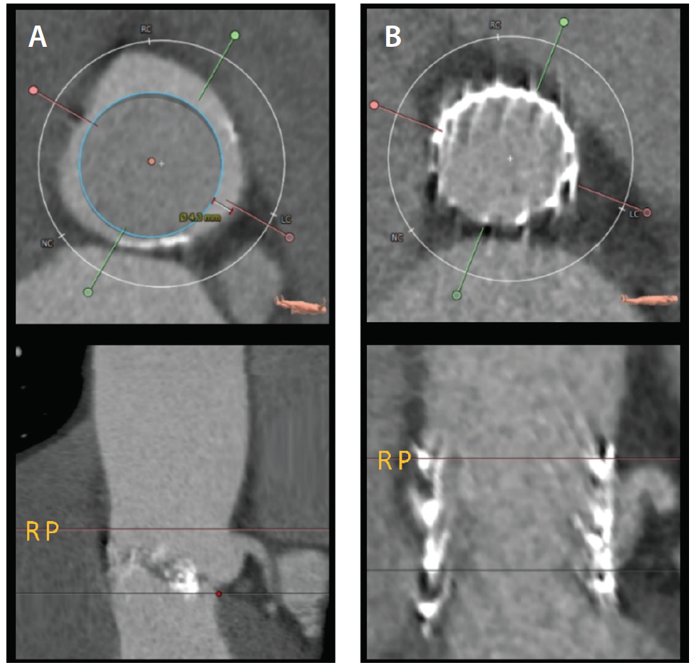 TAV-in-TAV: Future Considerations for Intermediate- and Low-Risk ...