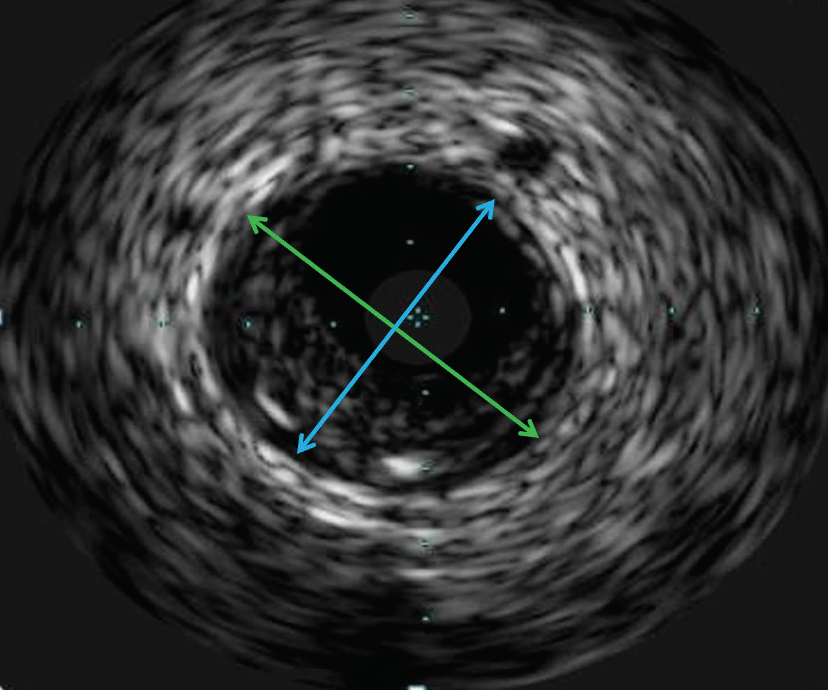 The Four Pillars of IVUS for the Endovascular Treatment of CLI ...
