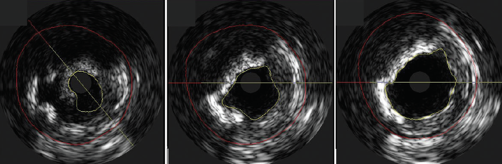 The Four Pillars of IVUS for the Endovascular Treatment of CLI ...