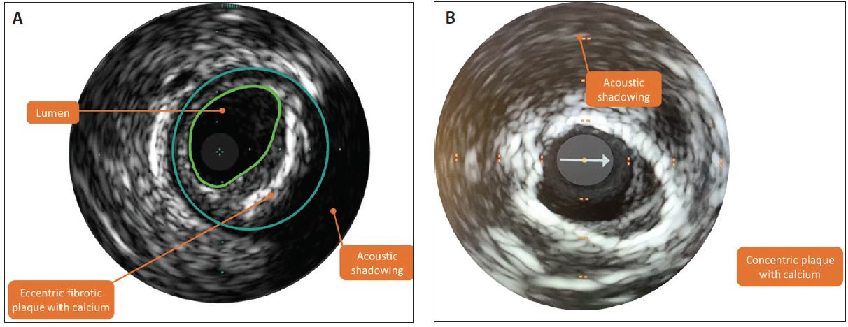 Challenges of Calcium in Critical Limb Ischemia - Endovascular Today