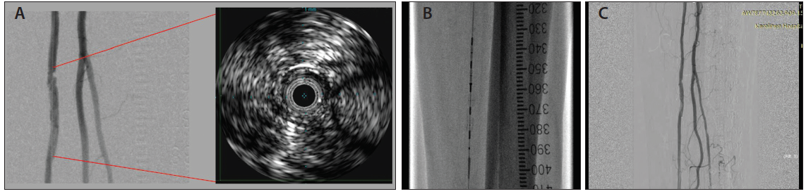Dissection Healing After Below-the-Knee Revascularization of CLTI ...