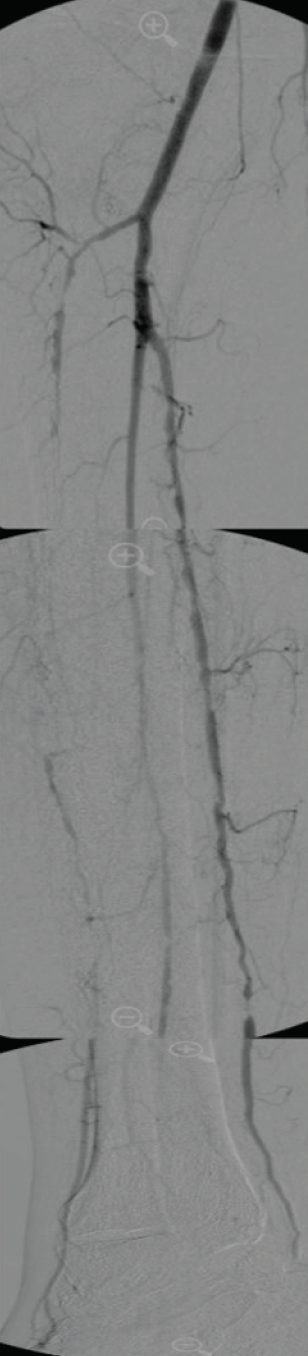 Case Report: Enhanced Tack Placement Using IVUS in Severe Stenosis of ...