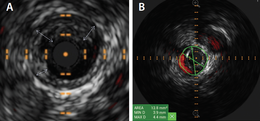 Case Report: Enhanced Tack Placement Using IVUS in Severe Stenosis of ...