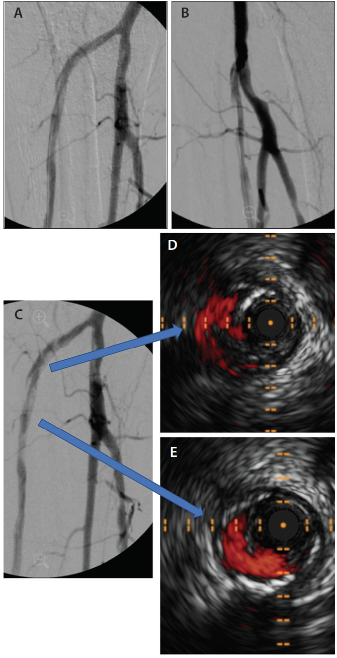 Case Report: Enhanced Tack Placement Using IVUS in Severe Stenosis of ...