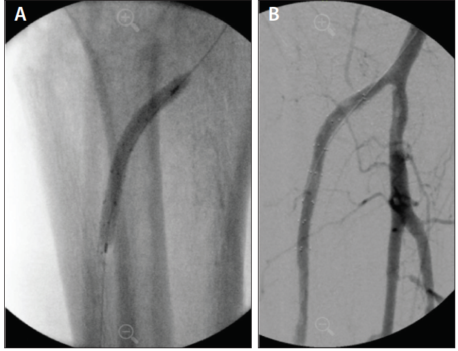 Case Report: Enhanced Tack Placement Using IVUS in Severe Stenosis of ...