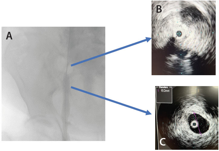 The Utility of IVUS in Dialysis Access - Endovascular Today