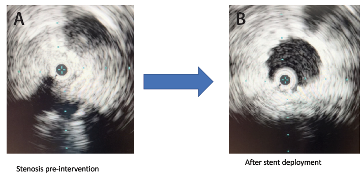The Utility of IVUS in Dialysis Access - Endovascular Today