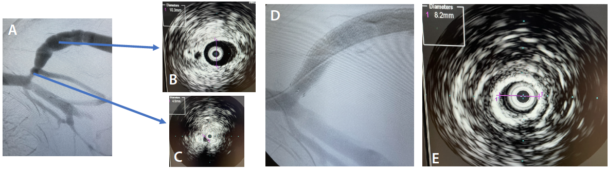 The Utility of IVUS in Dialysis Access - Endovascular Today