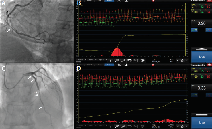 Pullback Pressure Gradient: Discriminating Focal and Diffuse Coronary ...