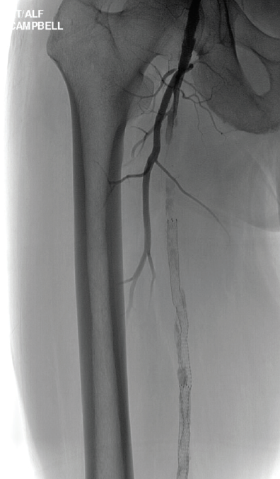 Computer-Aided Thrombus Removal Using Penumbra’s Lightning® 7 and ...