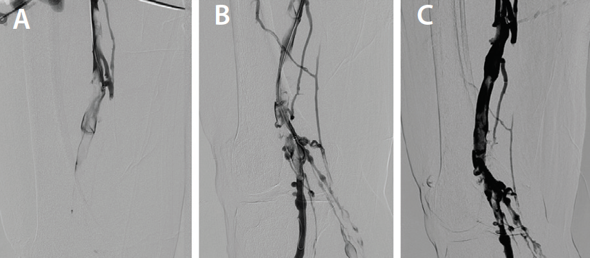 Mechanical Power Aspiration With the Indigo® System in Pulmonary Emboli ...