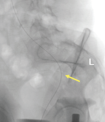 Iliac Vein Stenting: Best Practices for Patient Safety and Successful ...