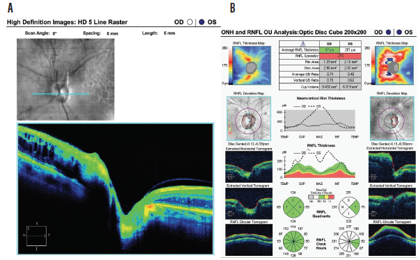 Radiation-Induced Optic Neuropathy After Choroidal Metastasis - Modern ...