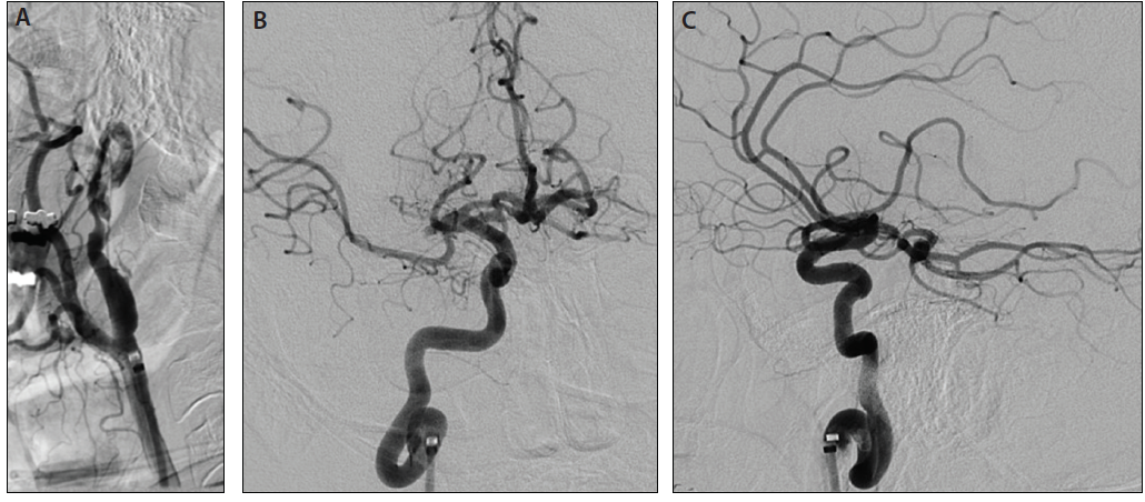 Tandem Occlusion With ICA Dissection - Endovascular Today