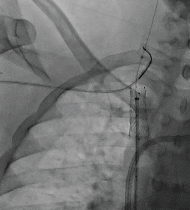 Chronic Upper Extremity AVG Thrombosis With Concomitant Central ...
