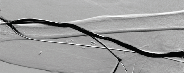 Chronic Upper Extremity AVG Thrombosis With Concomitant Central ...