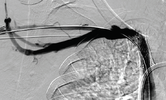 Chronic Upper Extremity AVG Thrombosis With Concomitant Central ...
