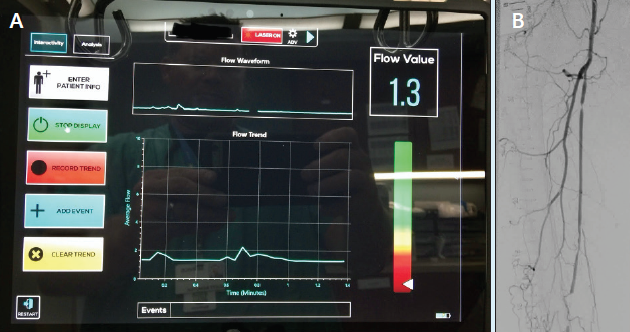 Time to Stop Doing Angiography in the Dark: The FlowMet™ Peripheral ...