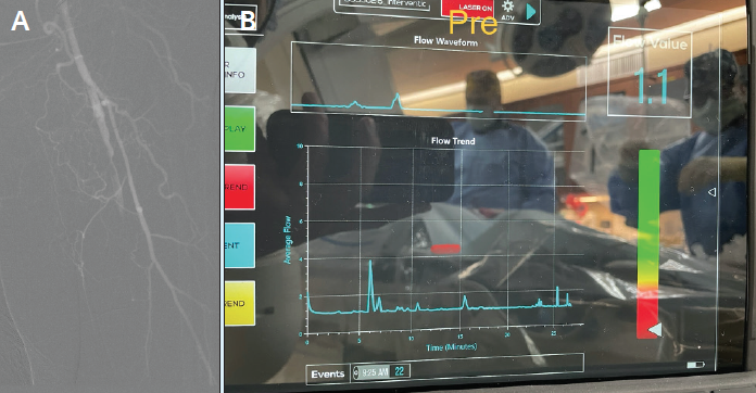 Time to Stop Doing Angiography in the Dark: The FlowMet™ Peripheral ...