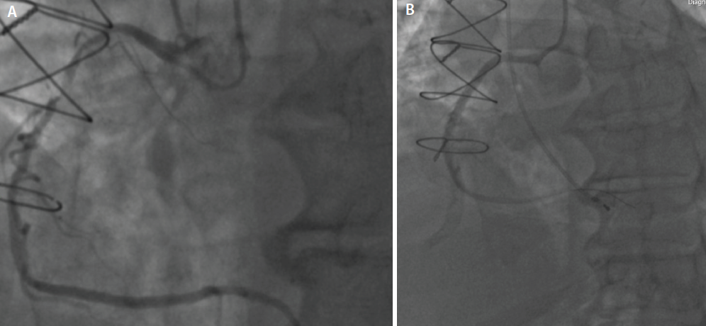 Making the Case for CI-AKI Prevention With the ACIST CVi™ Contrast ...