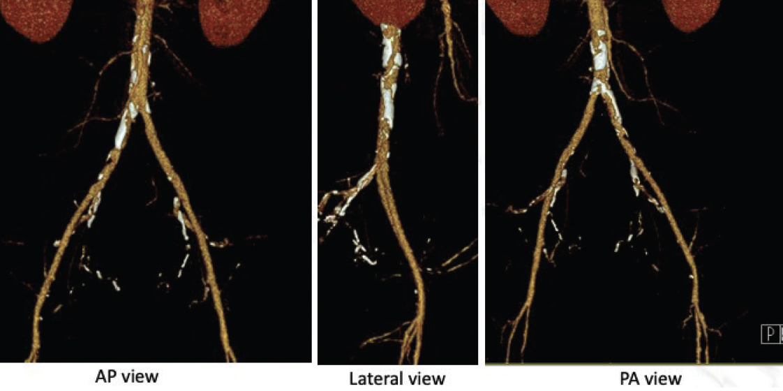 New Generation BX Covered Stent: Visibility and Conformability Were ...