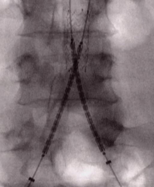 New Generation BX Covered Stent: Visibility and Conformability Were ...