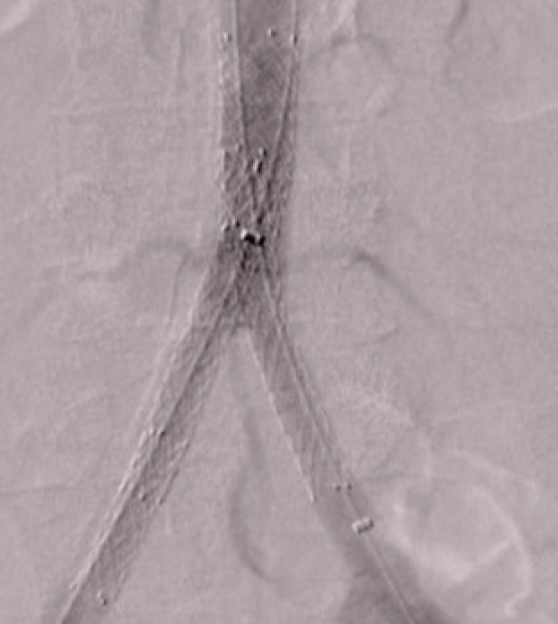 New Generation BX Covered Stent: Visibility and Conformability Were ...