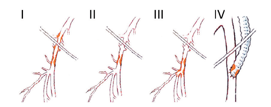 Panel Discussion: CFA Disease: Exploring Options in a Typically ...