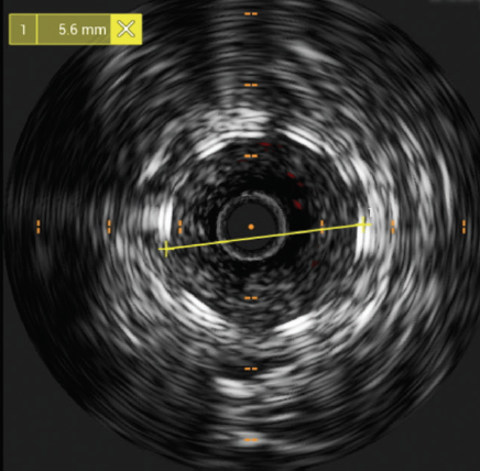 Introduction to the PATHFINDER Registry and Complex Endovascular Cases ...