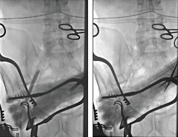 Saving Limbs to Save Lives: Holistic Approaches to Limb Salvage ...