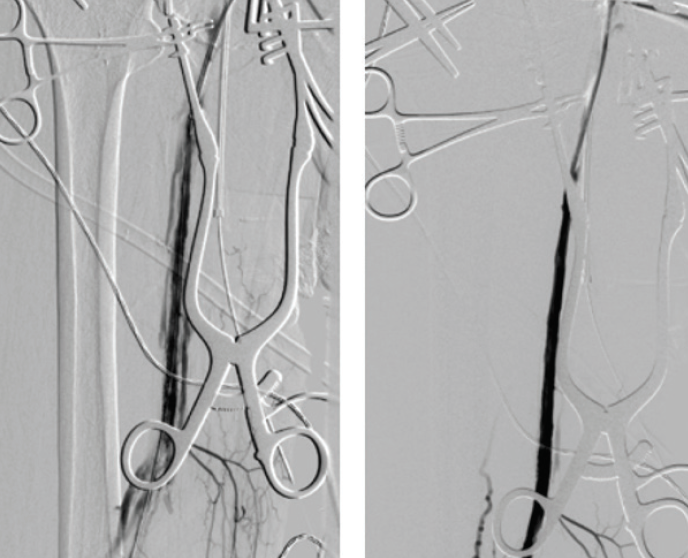 Saving Limbs to Save Lives: Holistic Approaches to Limb Salvage ...