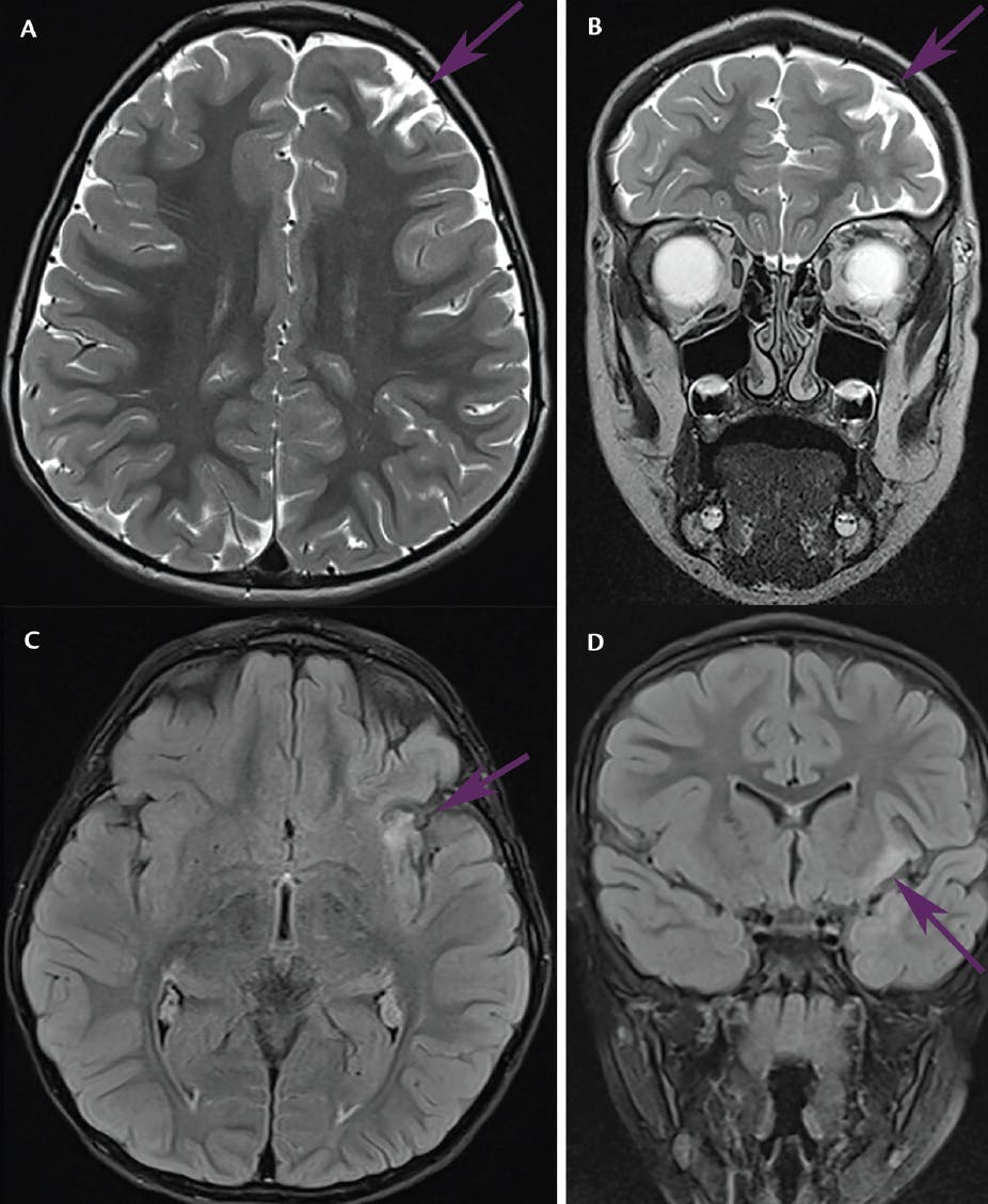 Epilepsy Brain Mri Magnetization Transfer MR Imaging In Patients With
