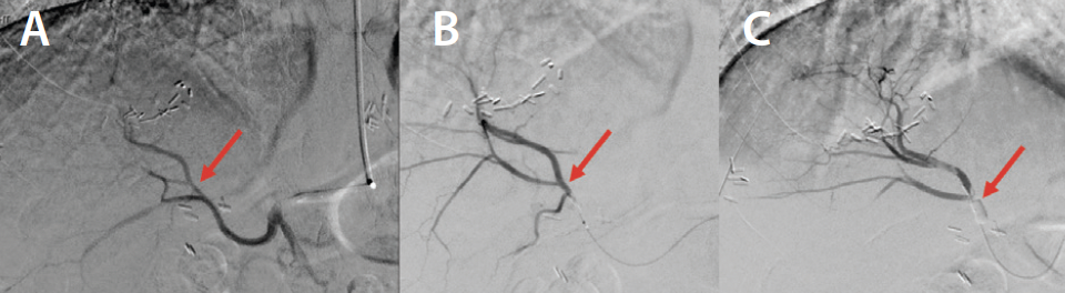 A Practical, Case-Based Approach to Yttrium-90 Radioembolization ...