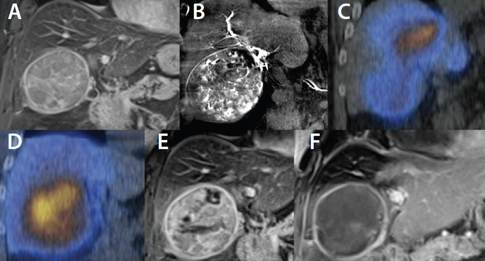 A Practical, Case-Based Approach to Yttrium-90 Radioembolization ...