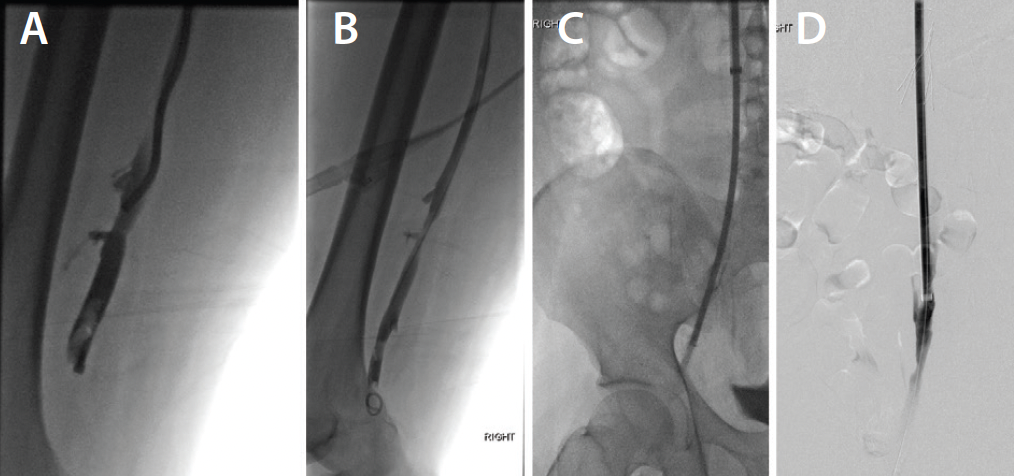 Percutaneous Mechanical Thrombectomy and Catheter-Directed Thrombolysis ...