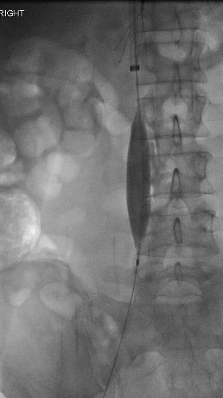 Percutaneous Mechanical Thrombectomy and Catheter-Directed Thrombolysis ...