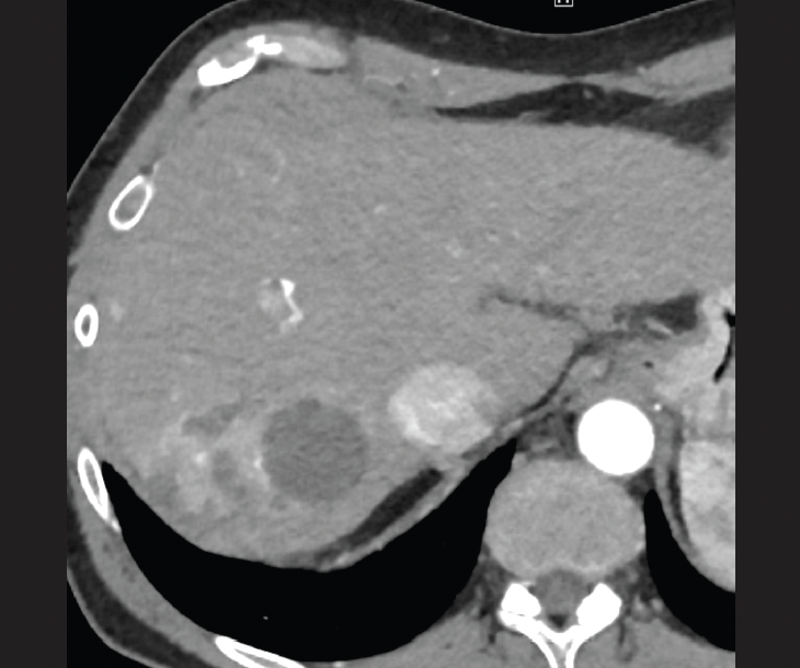 Managing Complications of Interventional Oncology Procedures ...