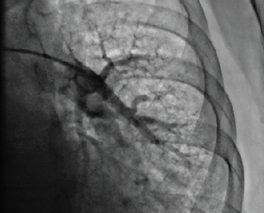 PERT Development and Implementation to Standardize Patient Pathway for ...